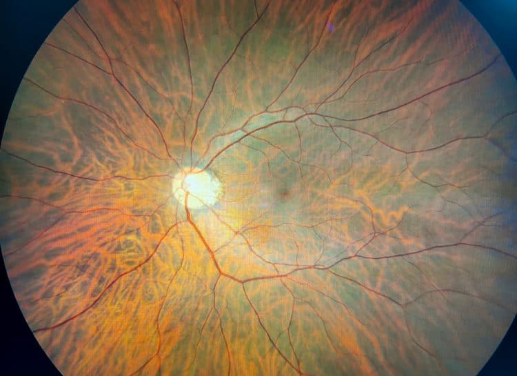 Optomap Imaging - South Georgia / North Florida Eye Partners